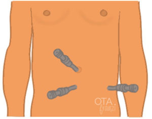 Leistenhernien - OTA Franzi